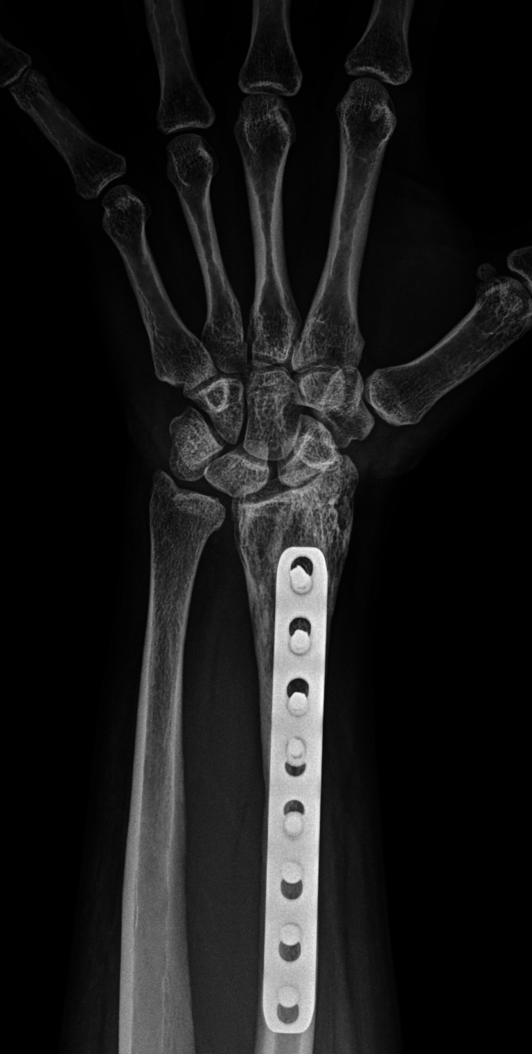 Osteoarticular allograft reconstruction after resection of the distal ...