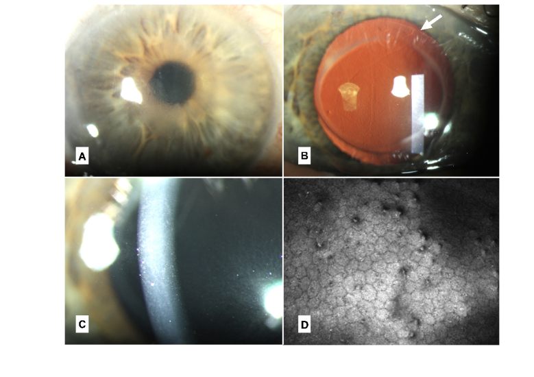 Donor-implanted Guttata in Transplanted Corneal Tissue: Clinical Signs ...